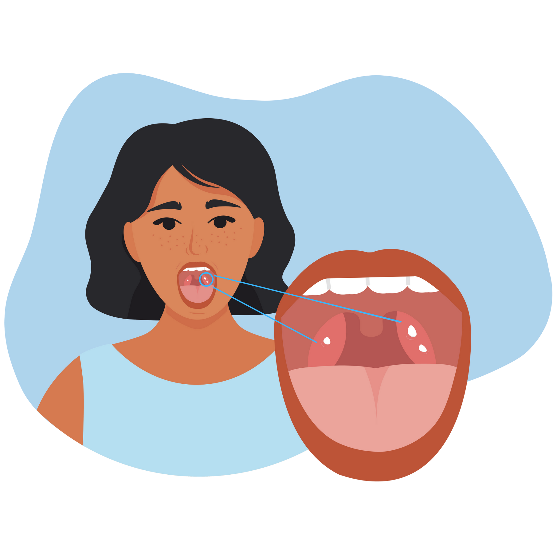 Tonsil Tech | #1 Tonsil Stone Removal Tools